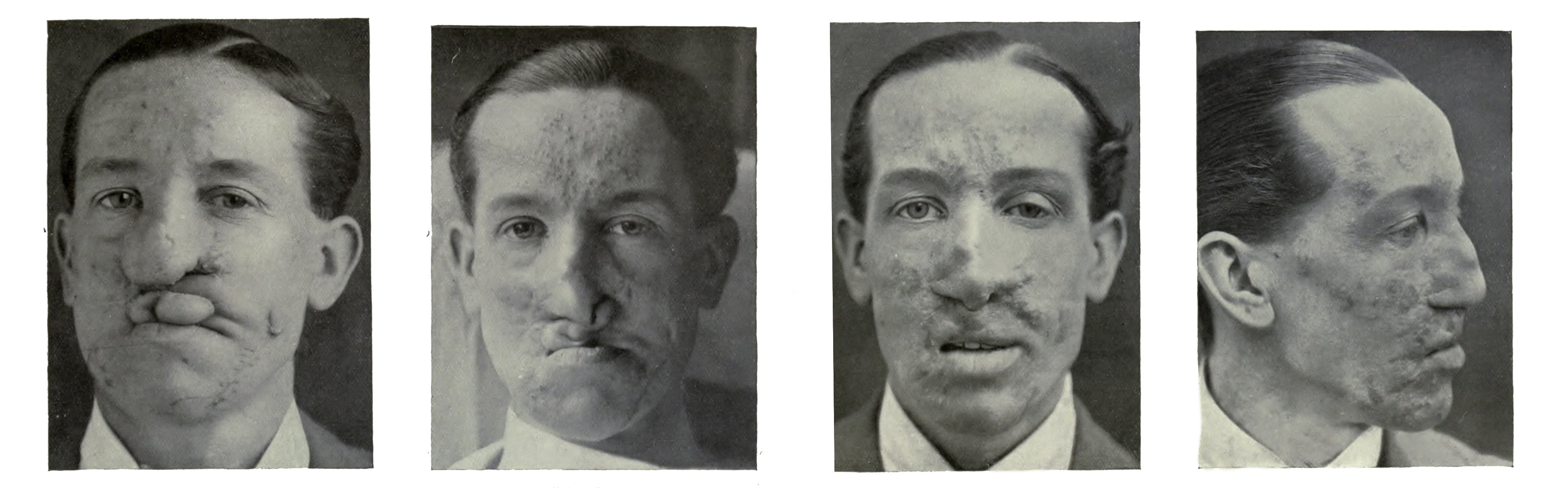 Innovative Cosmetic Surgery Restored WWI Vets' Ravaged Faces—And Lives ...