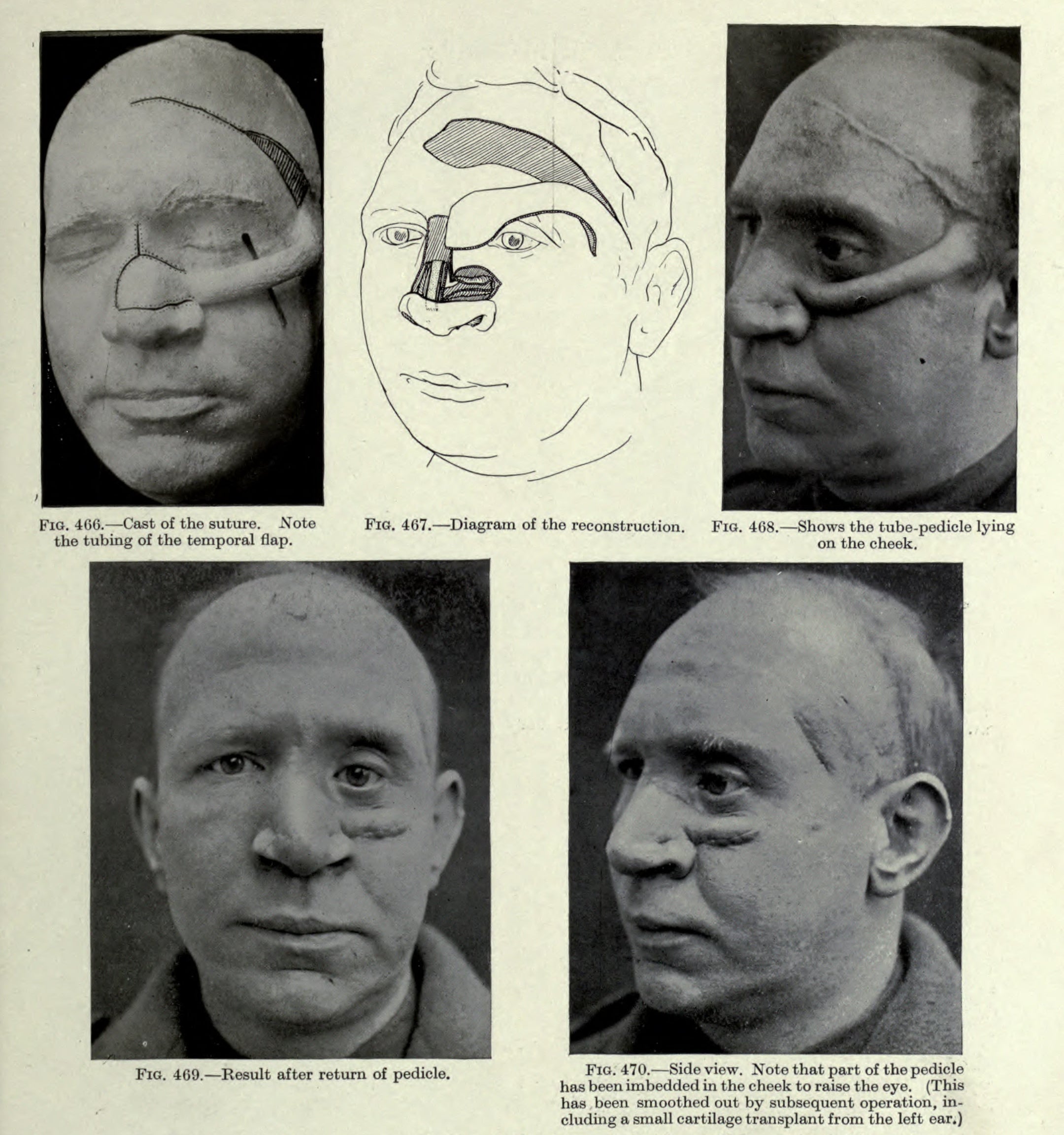 Innovative Cosmetic Surgery Restored WWI Vets' Ravaged Faces—And Lives ...