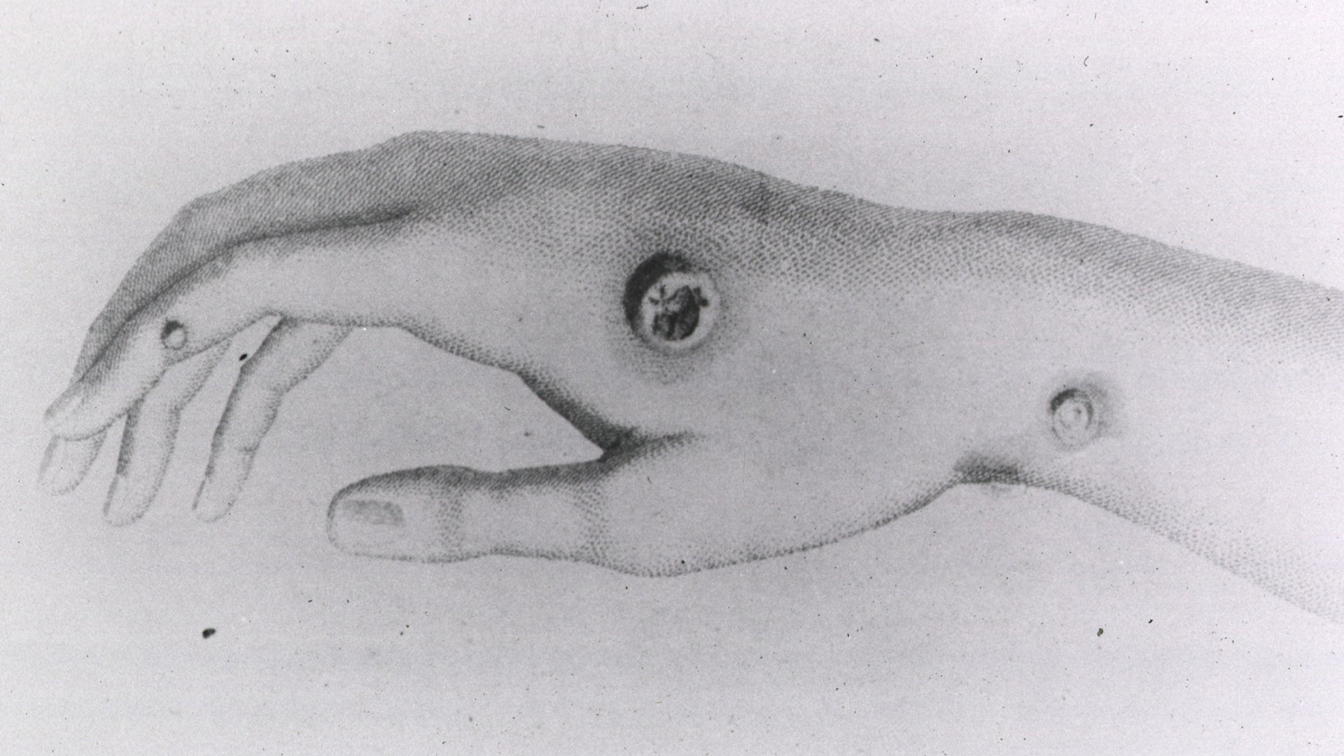 How Crude Smallpox Inoculations Helped George Washington Win the War ...